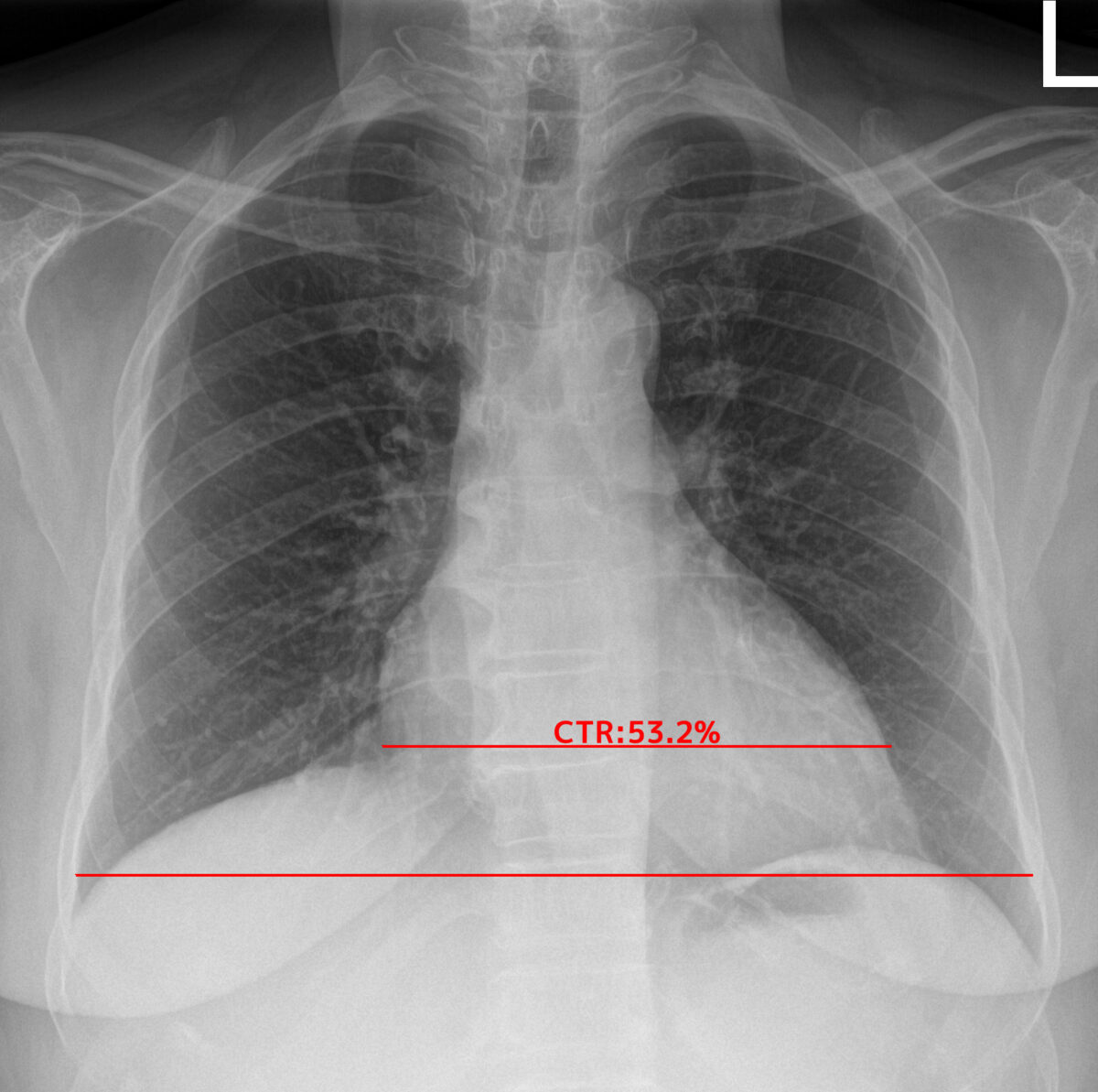 LPIXEL launched EIRL Chest Screening – a multifunctional renewal model ...